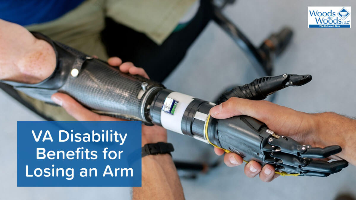 VA Loss of Limb Compensation for Arms and Hands