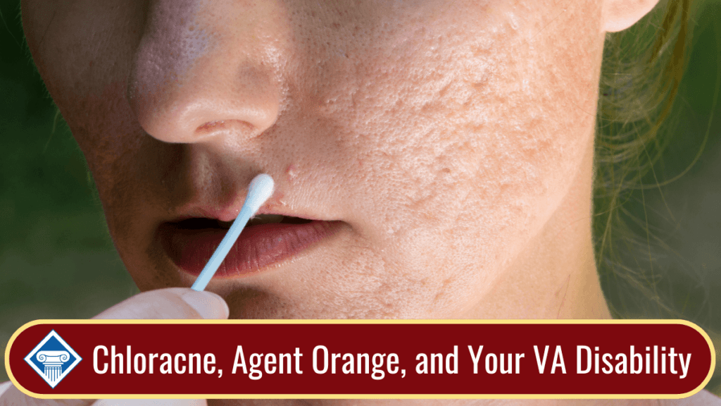 Chloracne, Agent Orange, and your VA disability