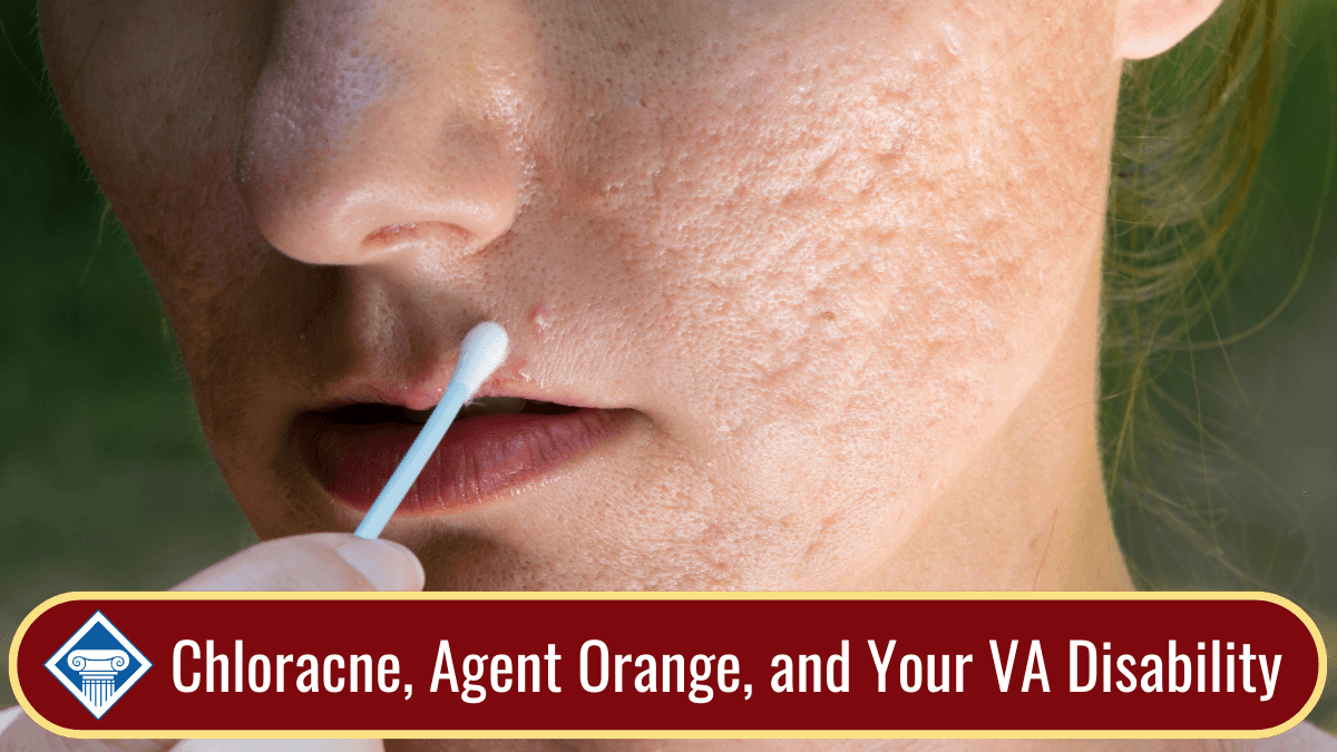 Chloracne, Agent Orange, and your VA disability